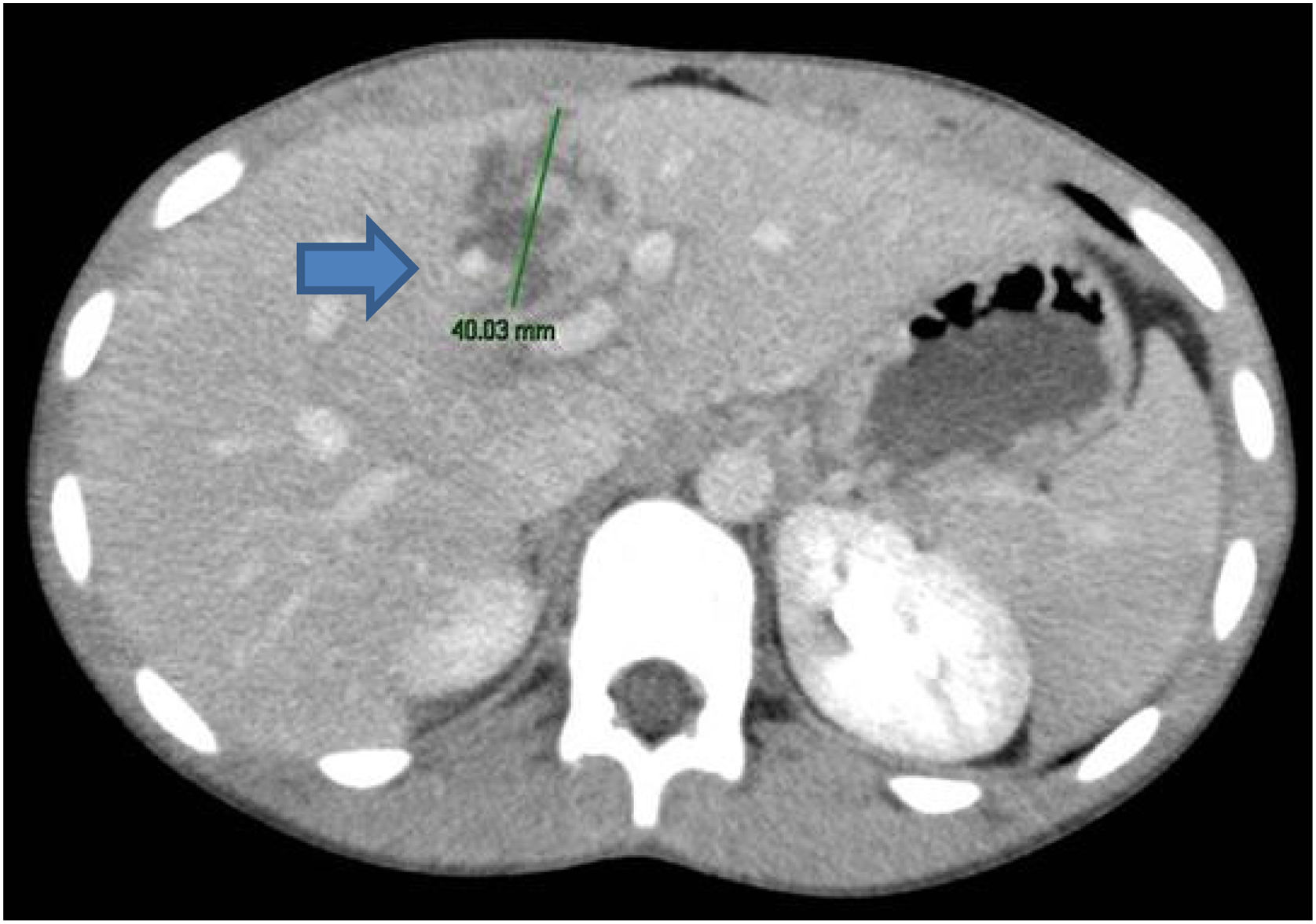 Nonoperative management in a patient with moderate blunt liver trauma ...