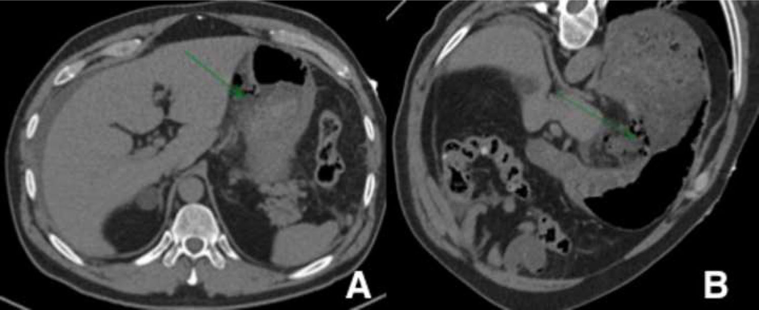 Spontaneous rupture of the stomach secondary to bicarbonate ingestion ...