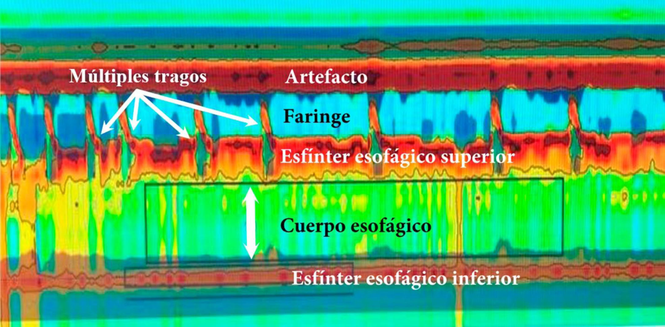 Allgrove syndrome in a toddler: Alacrima and achalasia, with no adrenal ...