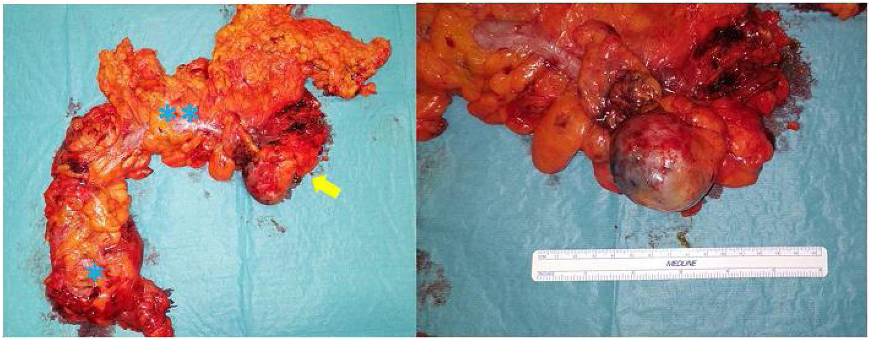 Dumbbell-shaped leiomyoma of the transverse colon | Revista de ...