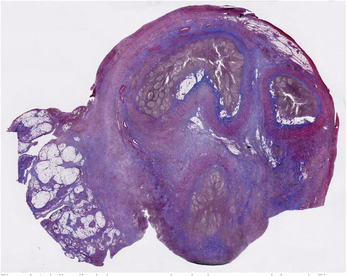 Tri-luminal septate appendix: A morphologic variant of septa with ...