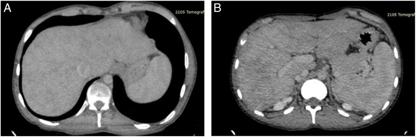 Fontan-associated liver disease: A case report and literature review ...