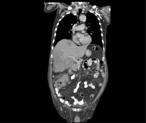 Intestinal obstruction and liver metastases secondary to carcinoma of ...