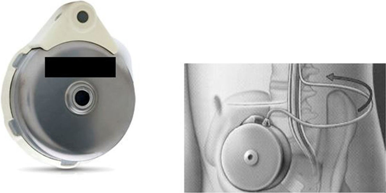 Total spinal block after local anesthetic administration through the ...