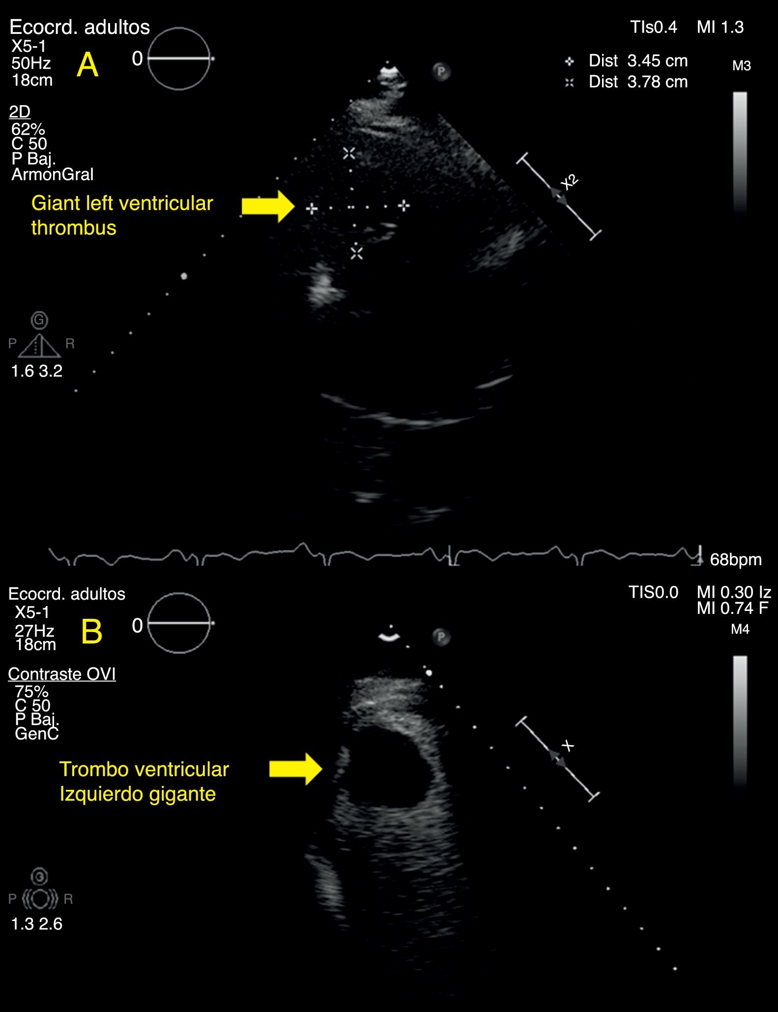 Giant left ventricular thrombus embolism into the abdominal aorta ...