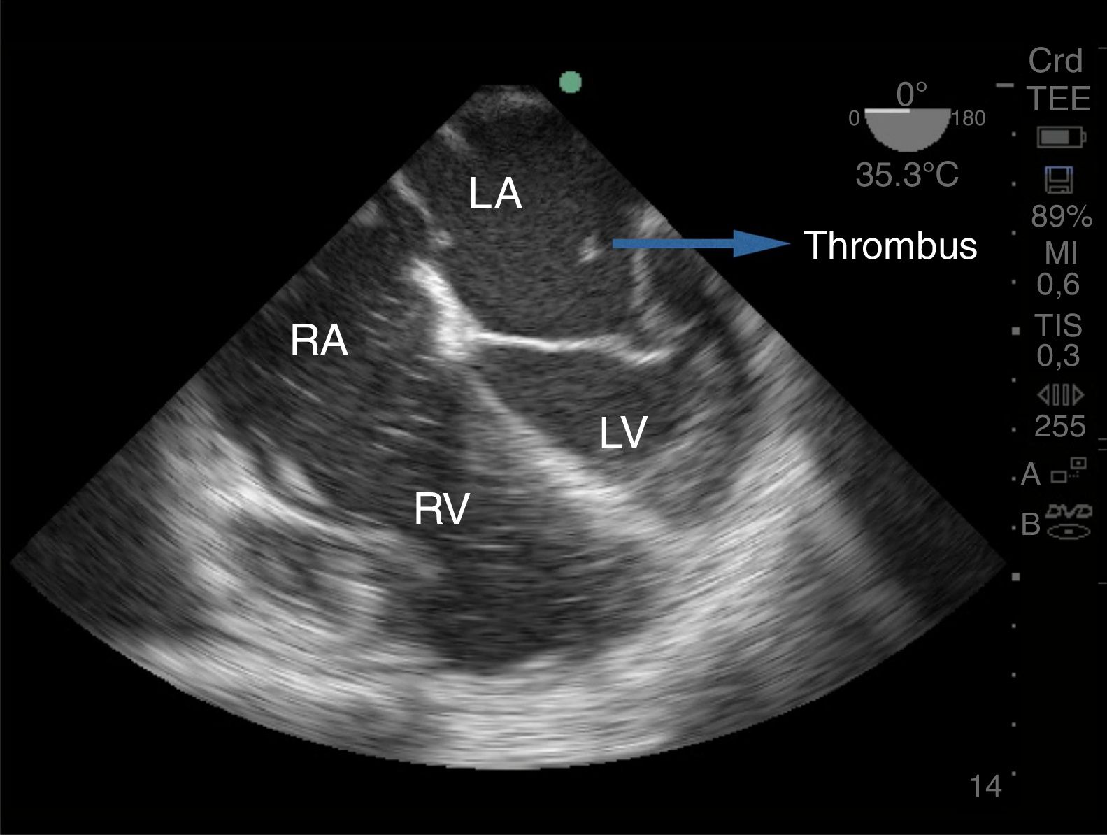Intracardiac tromboembolism during liver transplantation | Revista ...