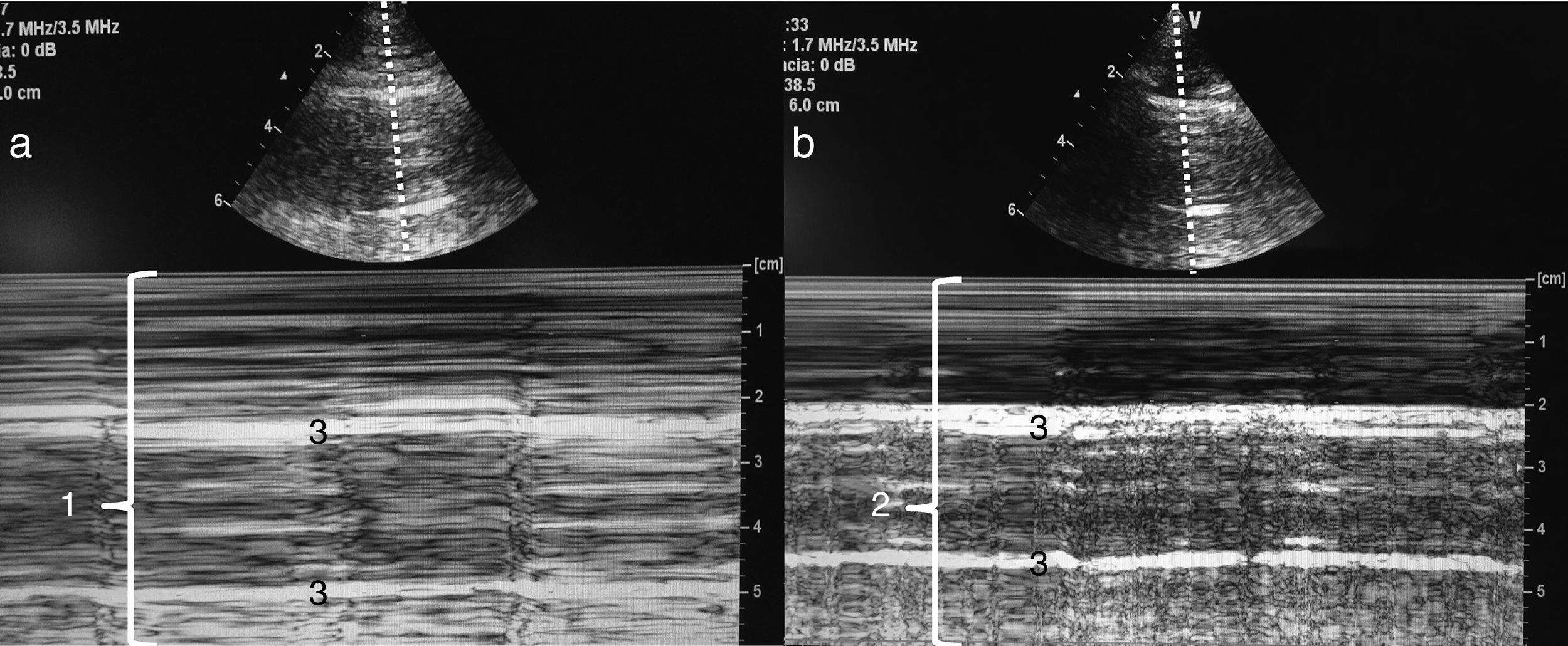 Pneumothorax: Immediate ultrasound diagnosis in the critical patient ...