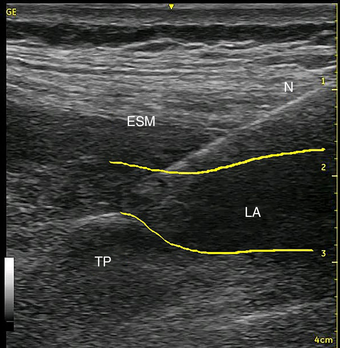 Lumbar erector spinae plane block: Successful control of acute pain ...
