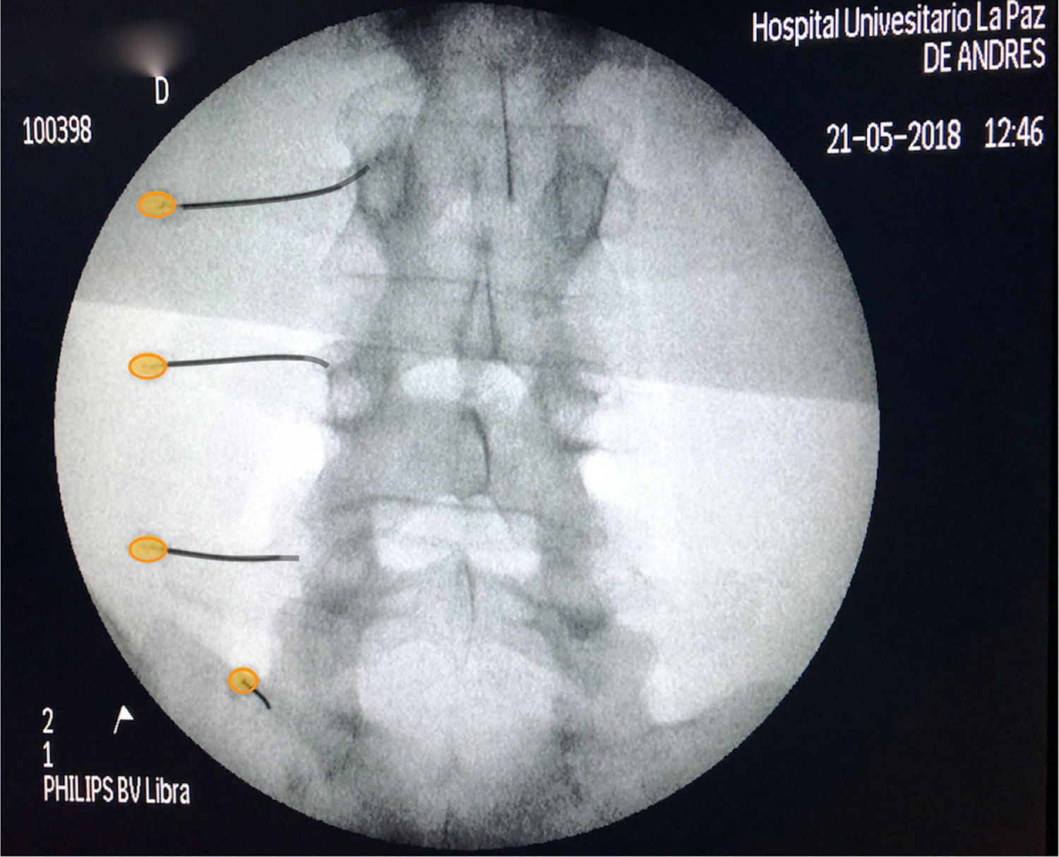 Diagnostic nerve blocks in the management of low back pain secondary to ...
