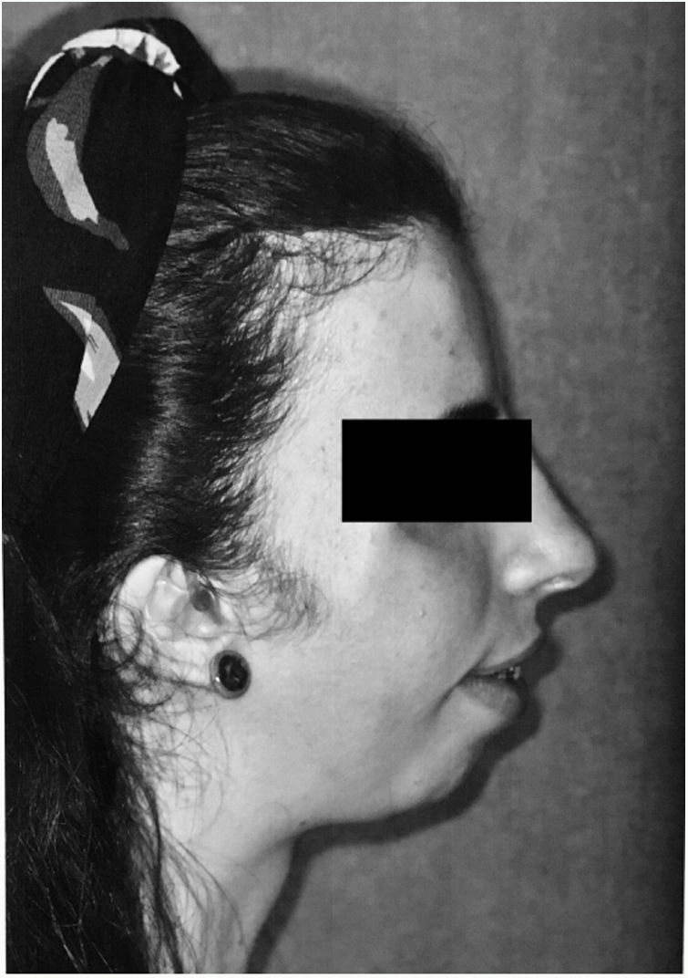 Difficult airway management in a patient with Treacher Collins syndrome ...