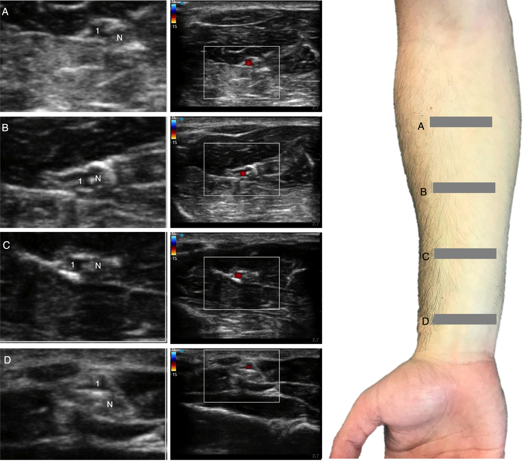 Median nerve block in the forearm and persistent median artery ...