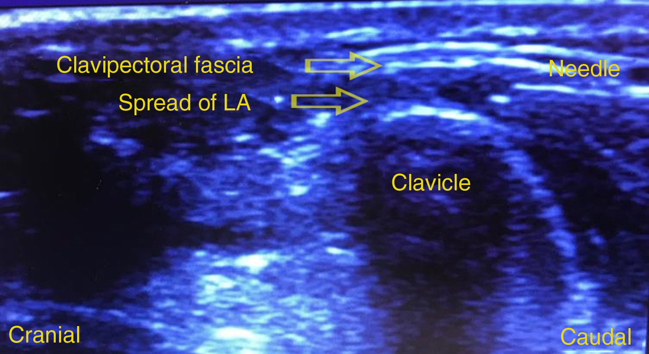 Clavipectoral fascia plane block for analgesia after clavicle surgery ...