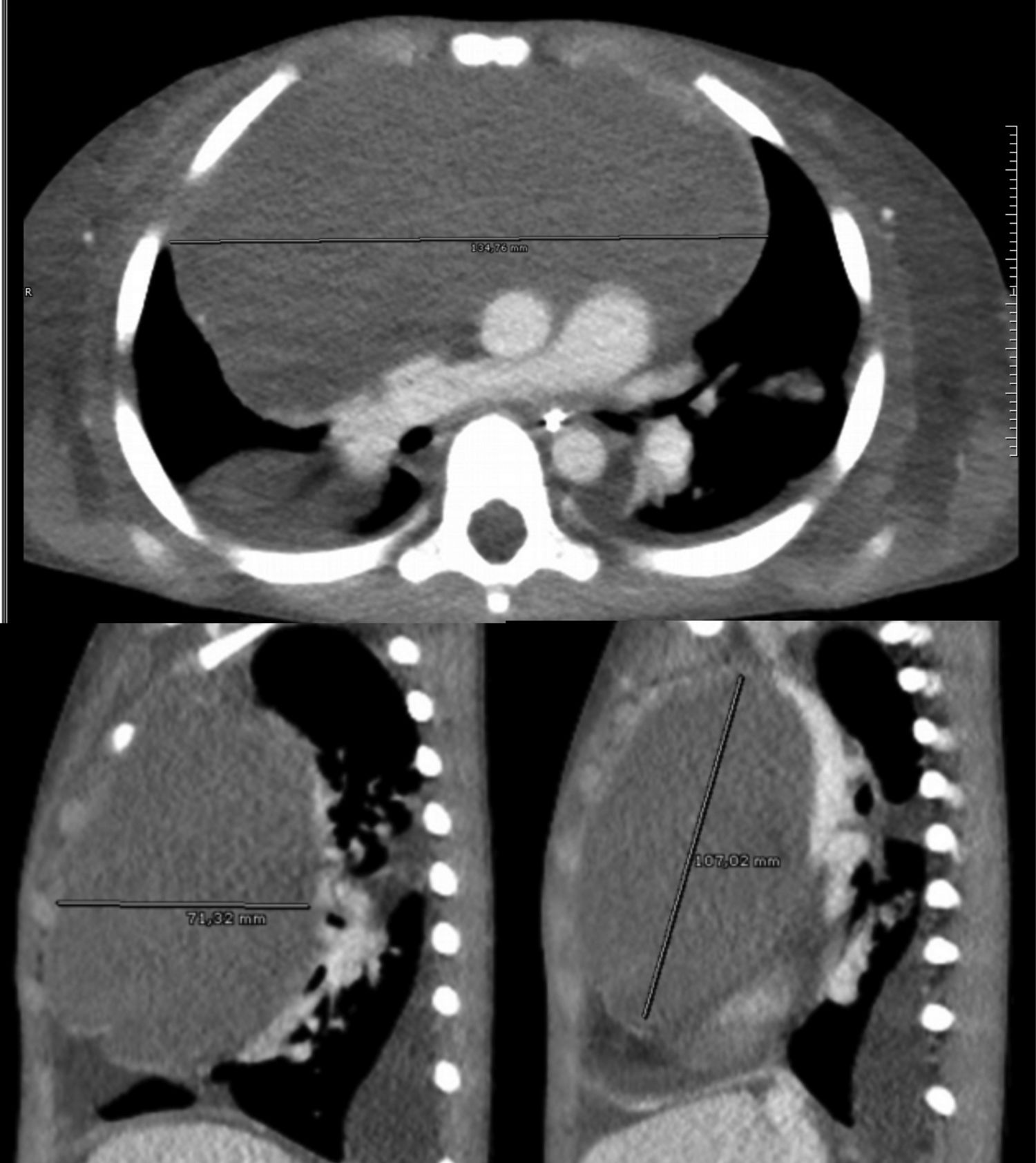 Anesthetic management during anterior mediastinal mass resection in a ...