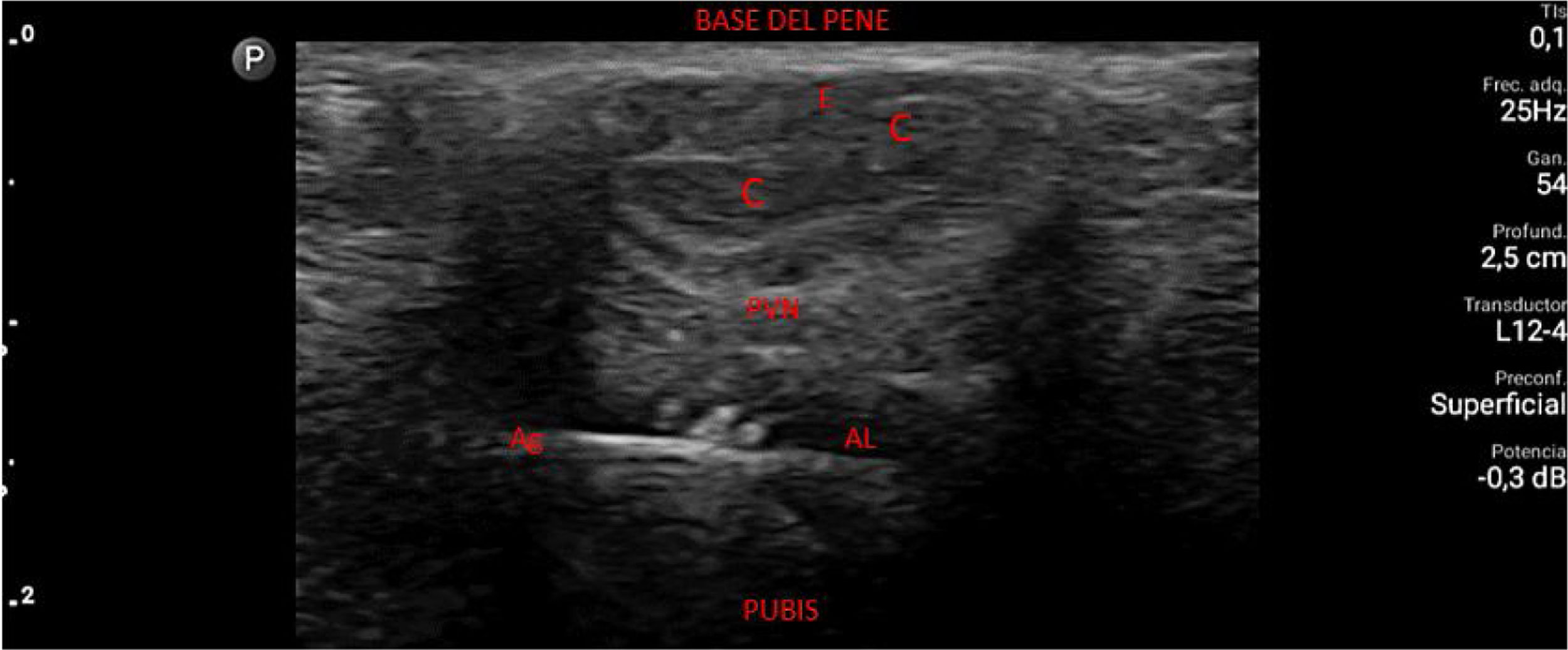 Ultrasound-guided penile nerve block in paediatrics | Revista Española ...