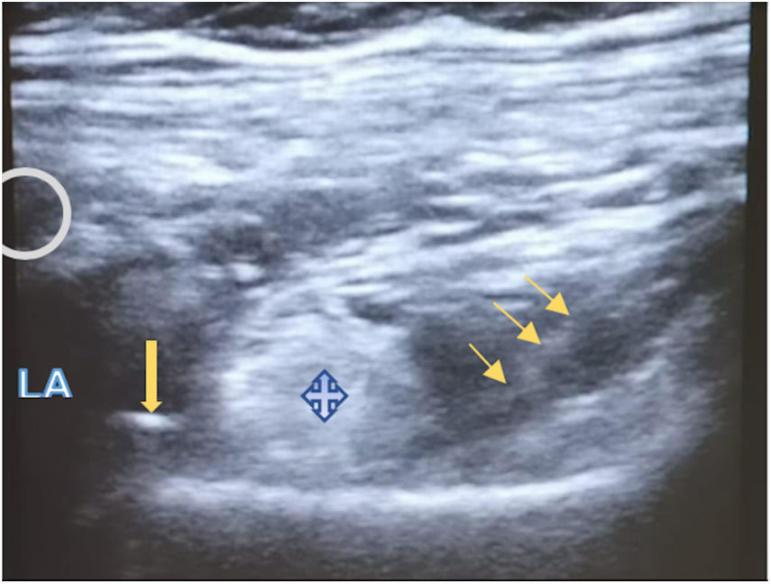 Continuous pericapsular nerve group blockade as analgesia for fracture ...