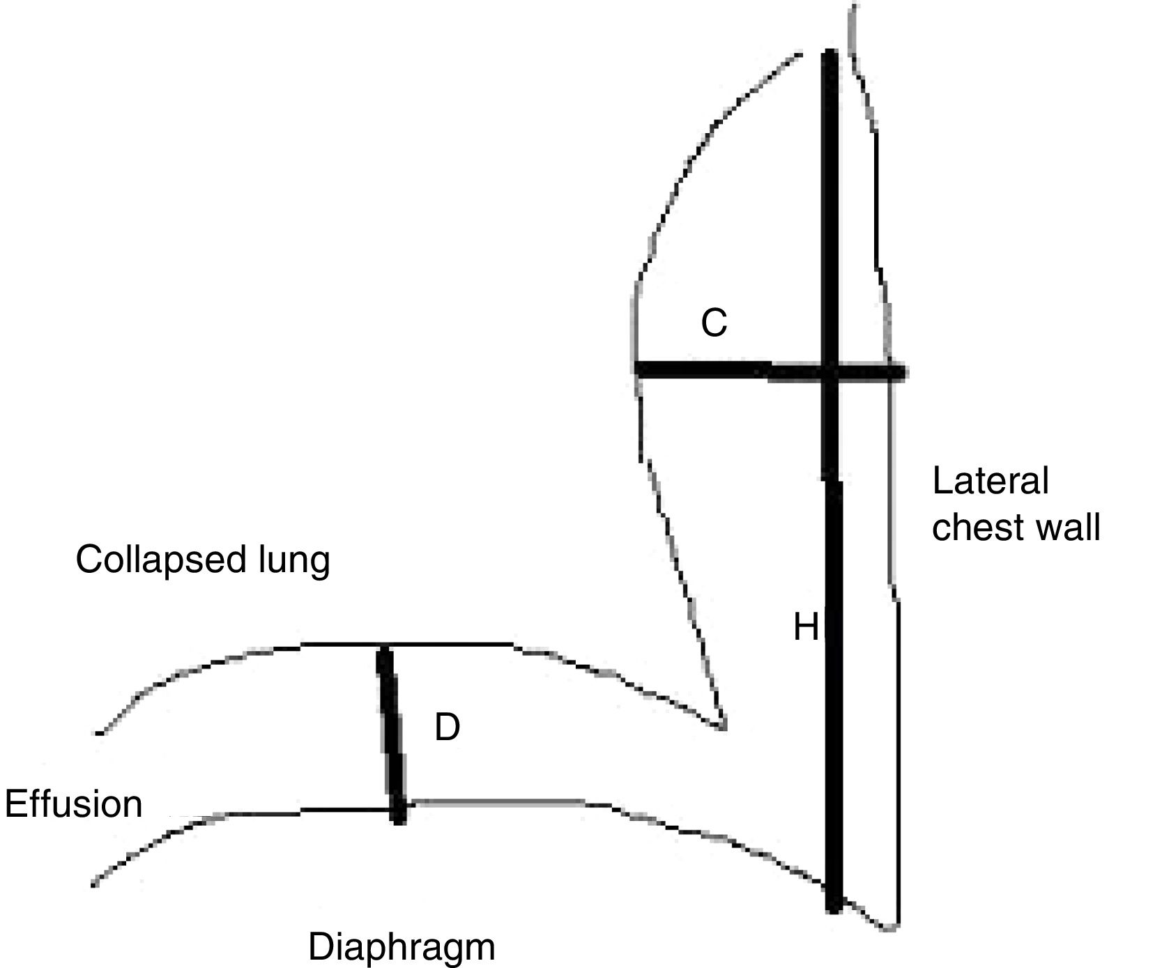 Methods of estimation of pleural effusion by ecography | Revista ...