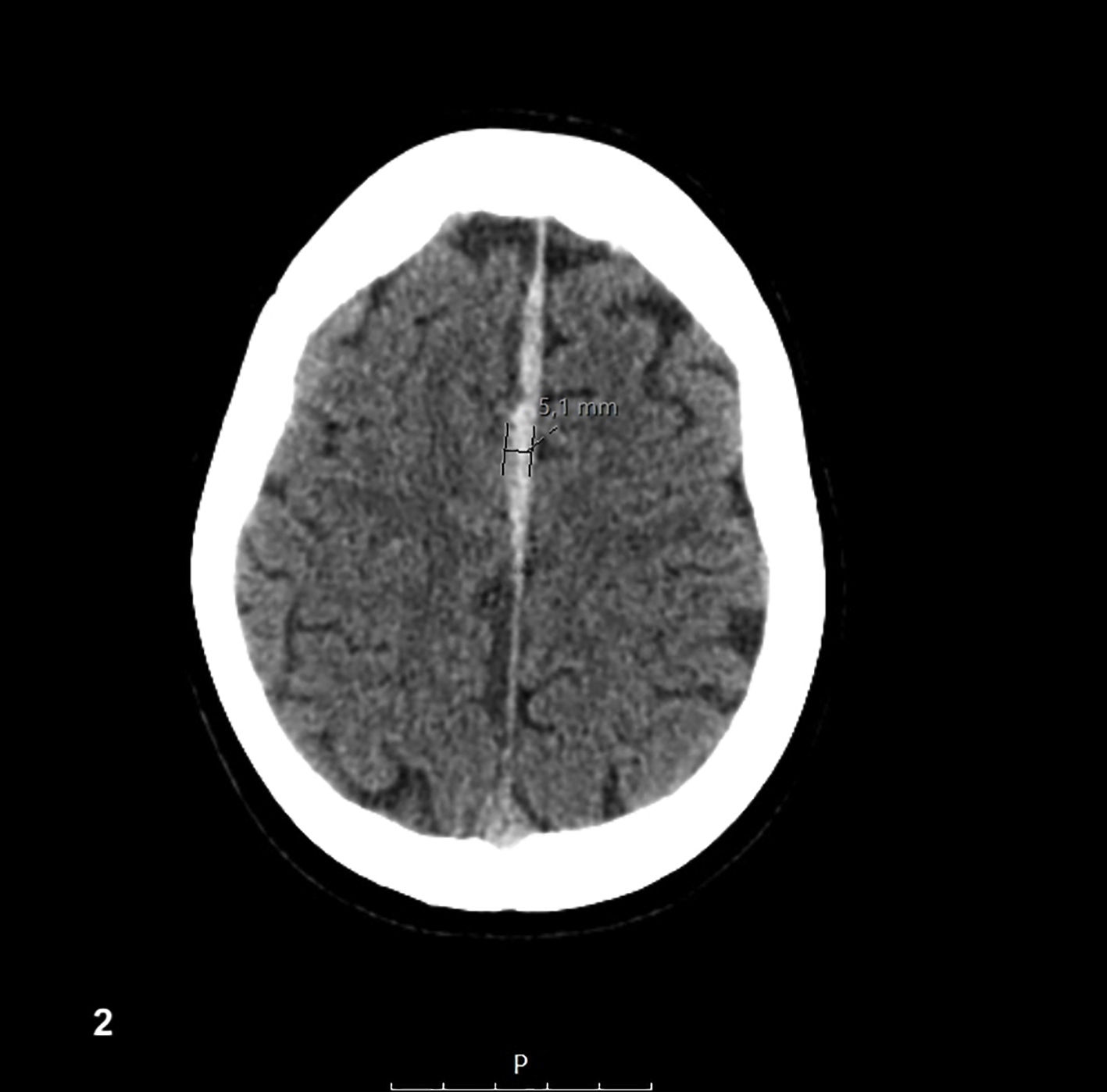 Intracranial subdural haematoma following dural puncture accidental ...