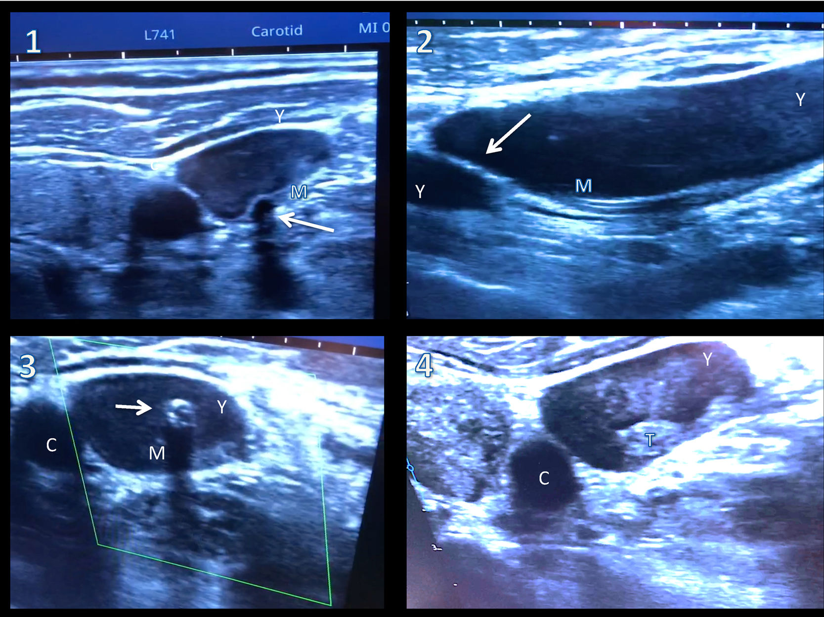 Internal jugular vein dissection after central venous catheter ...