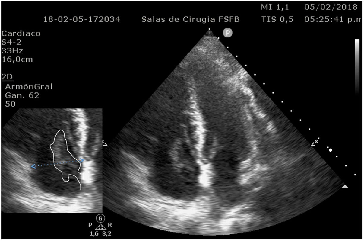 Chiari network diagnosis intraoperative based on echocardiography ...