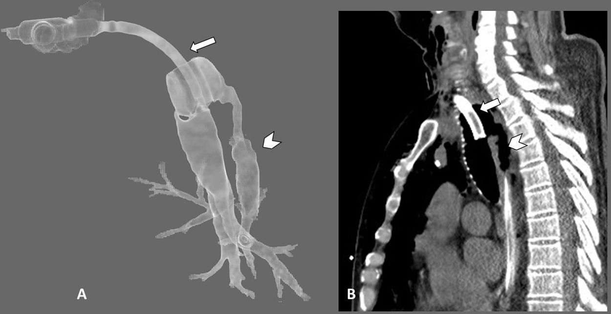 Iatrogenic tracheal rupture in a patient with acute respiratory ...