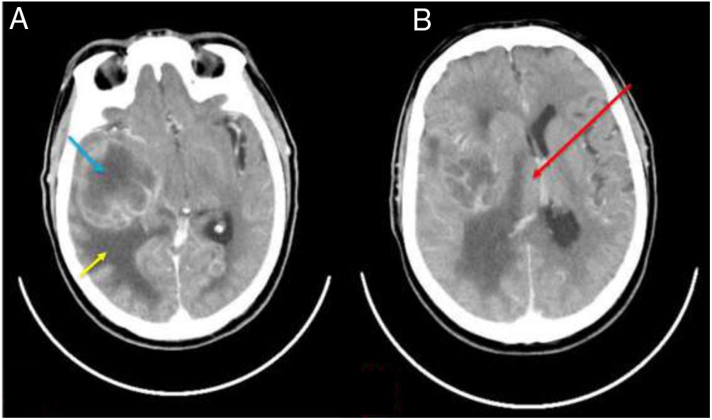 Delayed recovery of consciousness after anesthesia | Revista Española ...