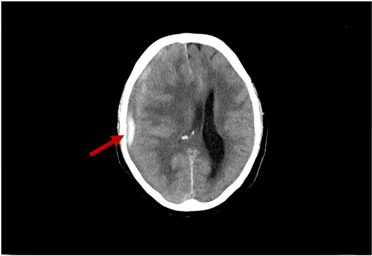 Acute subdural hematoma after dural puncture | Revista Española de ...