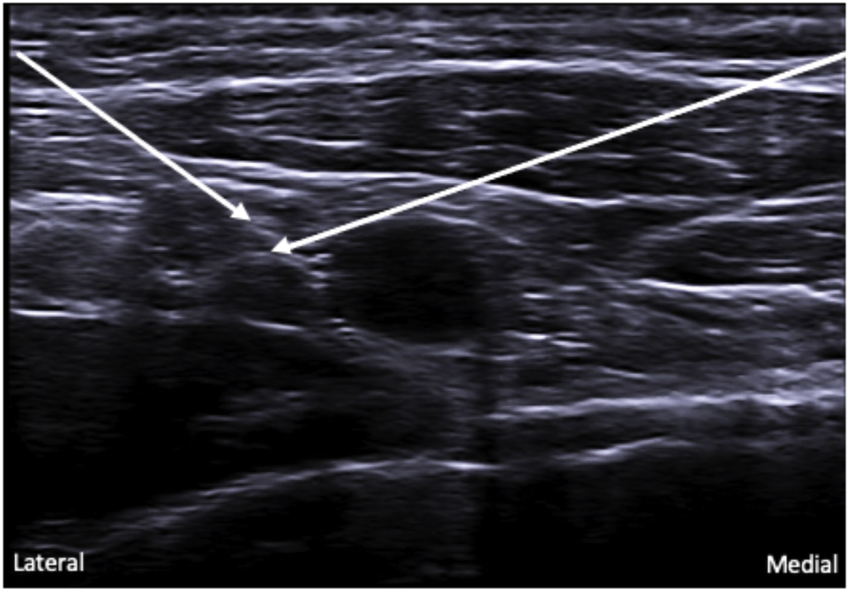 Costoclavicular brachial plexus block: A review of current evidence ...