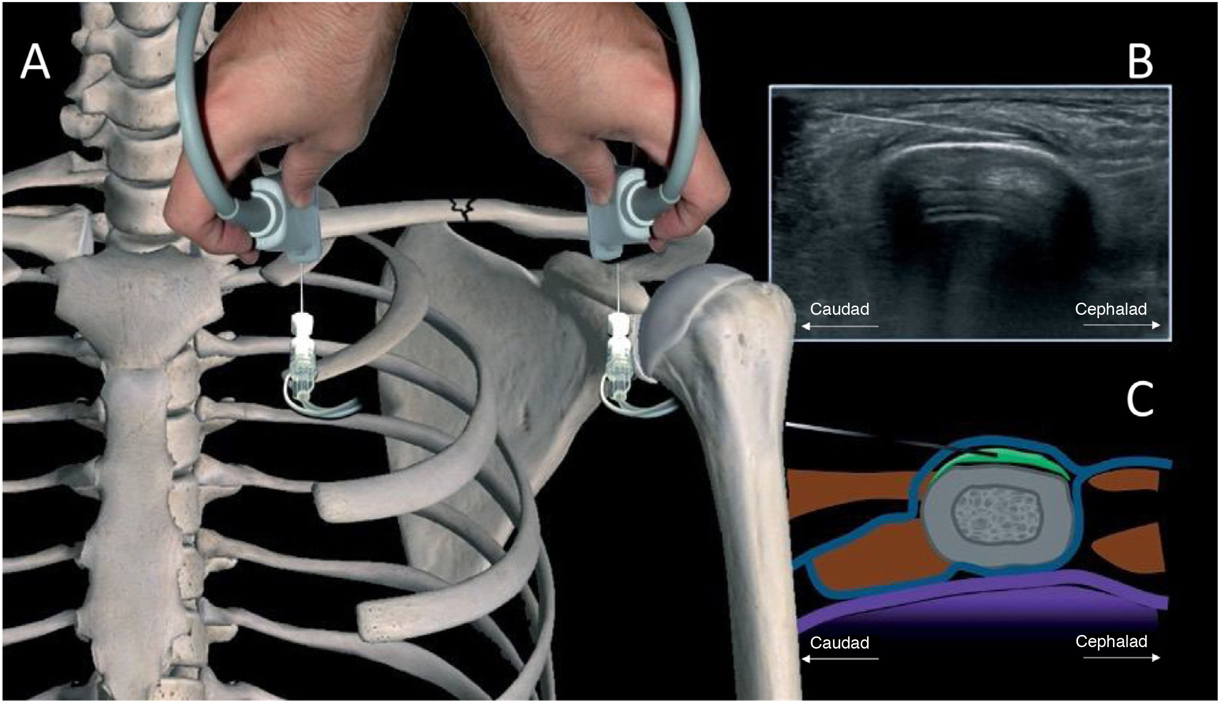 Ultrasound-guided clavipectoral fascia plane block for middle third ...
