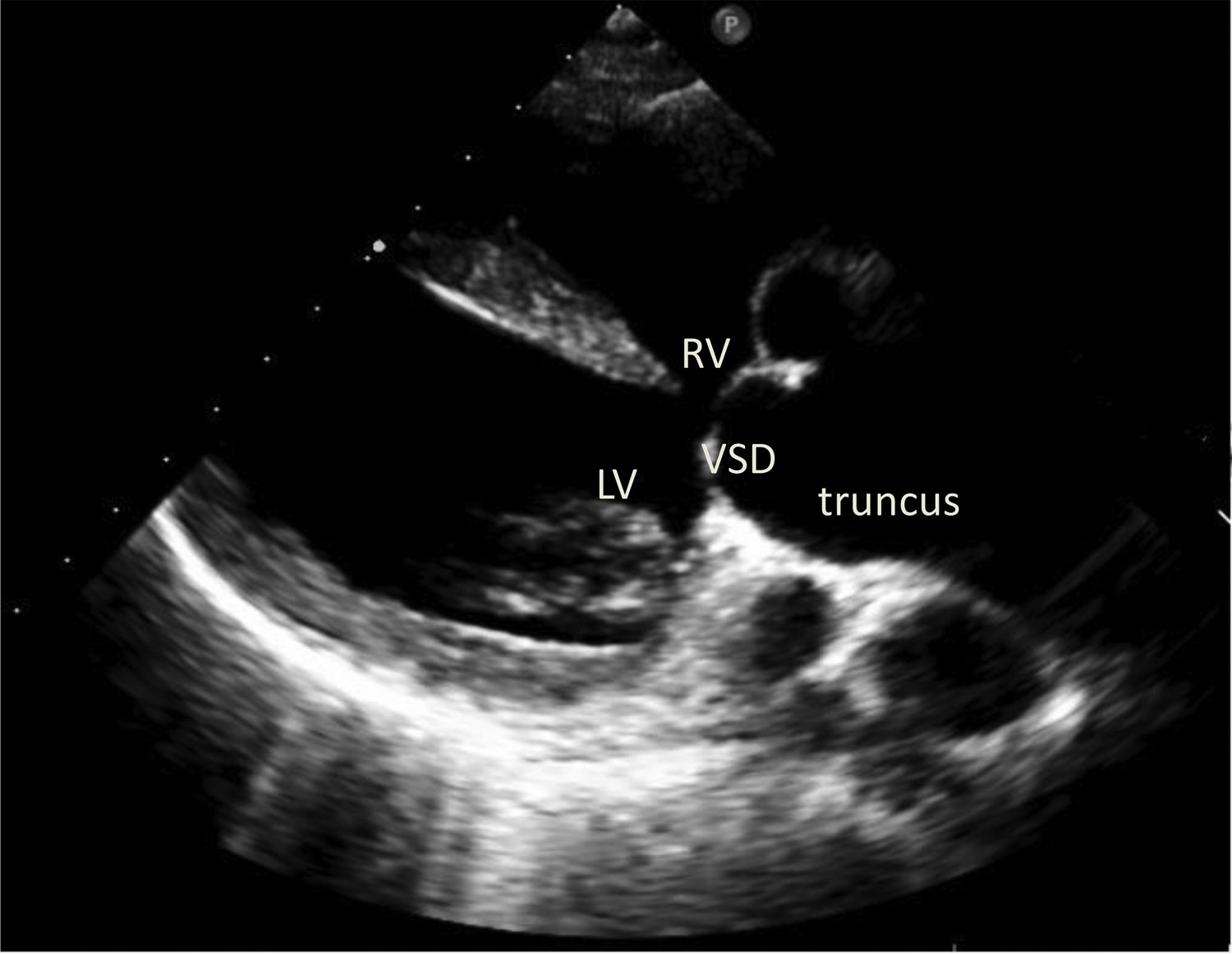 Laparoscopic radical resection for rectal cancer in a patient with ...
