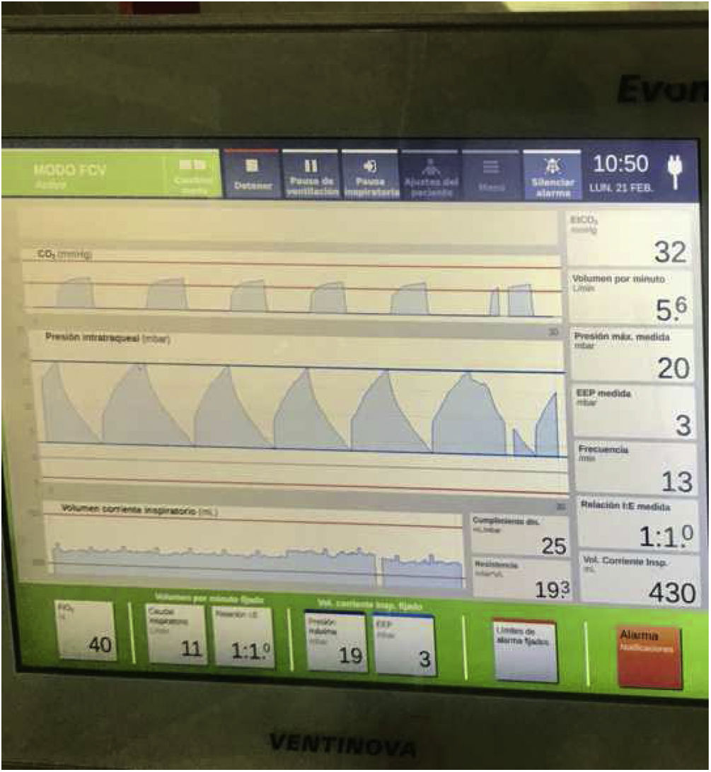 Flow-controlled ventilation and hi-flow nasal oxygen in laser surgery ...