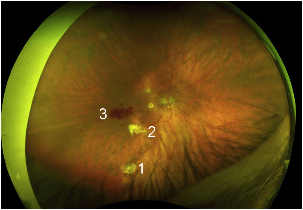 Retinal perforation and local anaesthetic toxicity after peribulbar ...