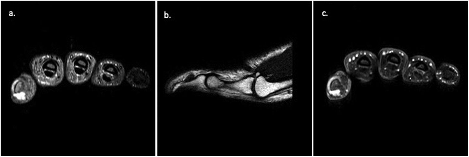 Glomus tumor causing chronic finger pain: ischemia test is a reliable ...