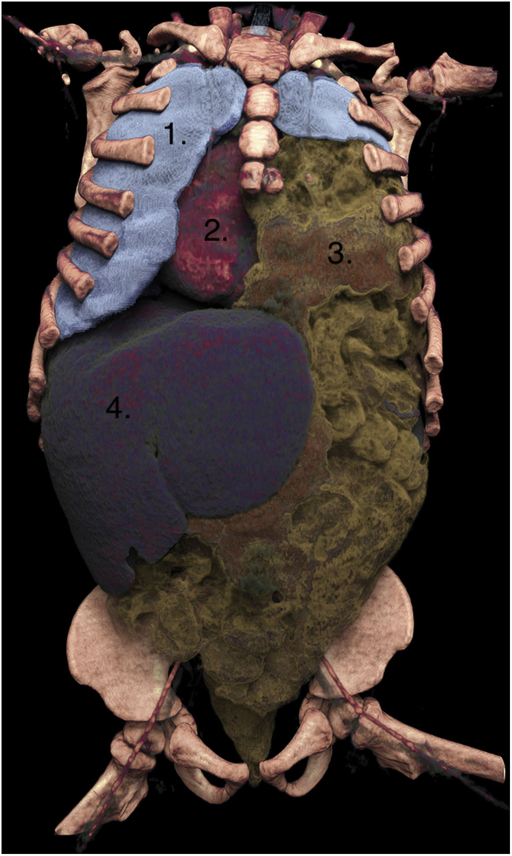 Congenital diaphragmatic hernia, Morgagni-Larrey type | Revista ...