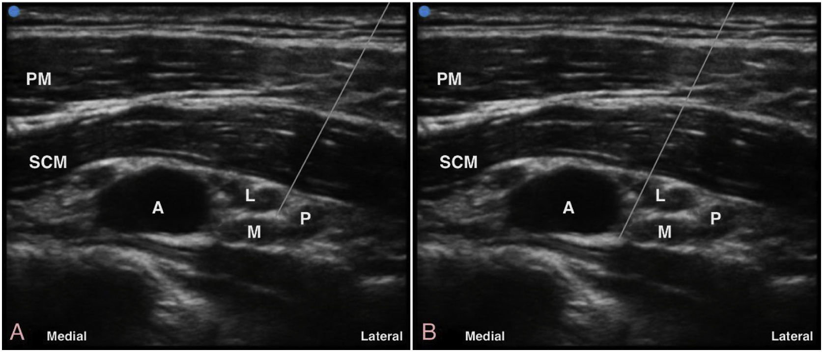 A comparative study between single injection (corner pocket approach ...