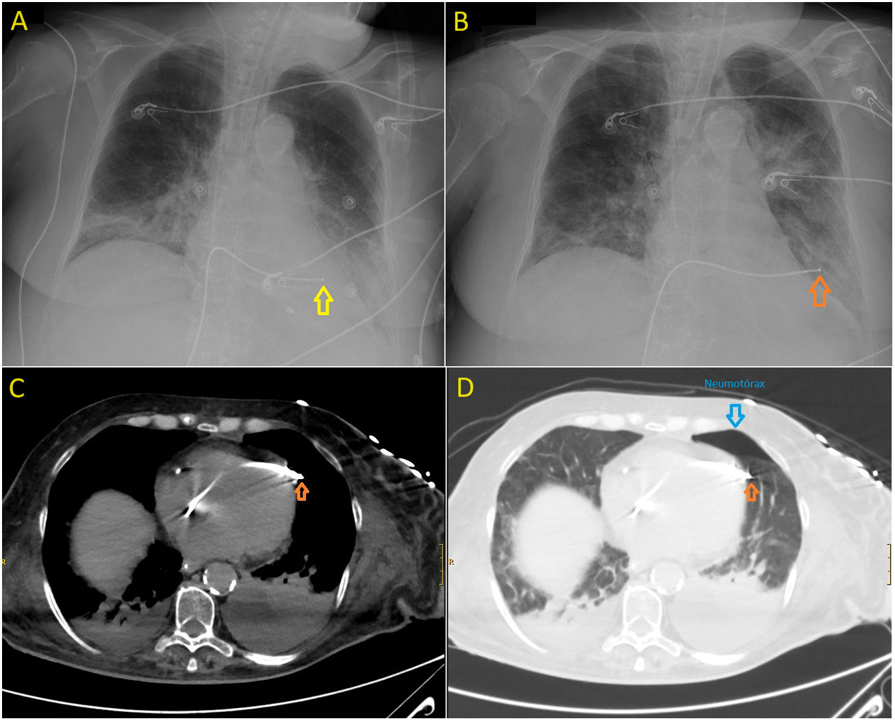 Simultaneous cardiac perforation and left pneumothorax as complications ...