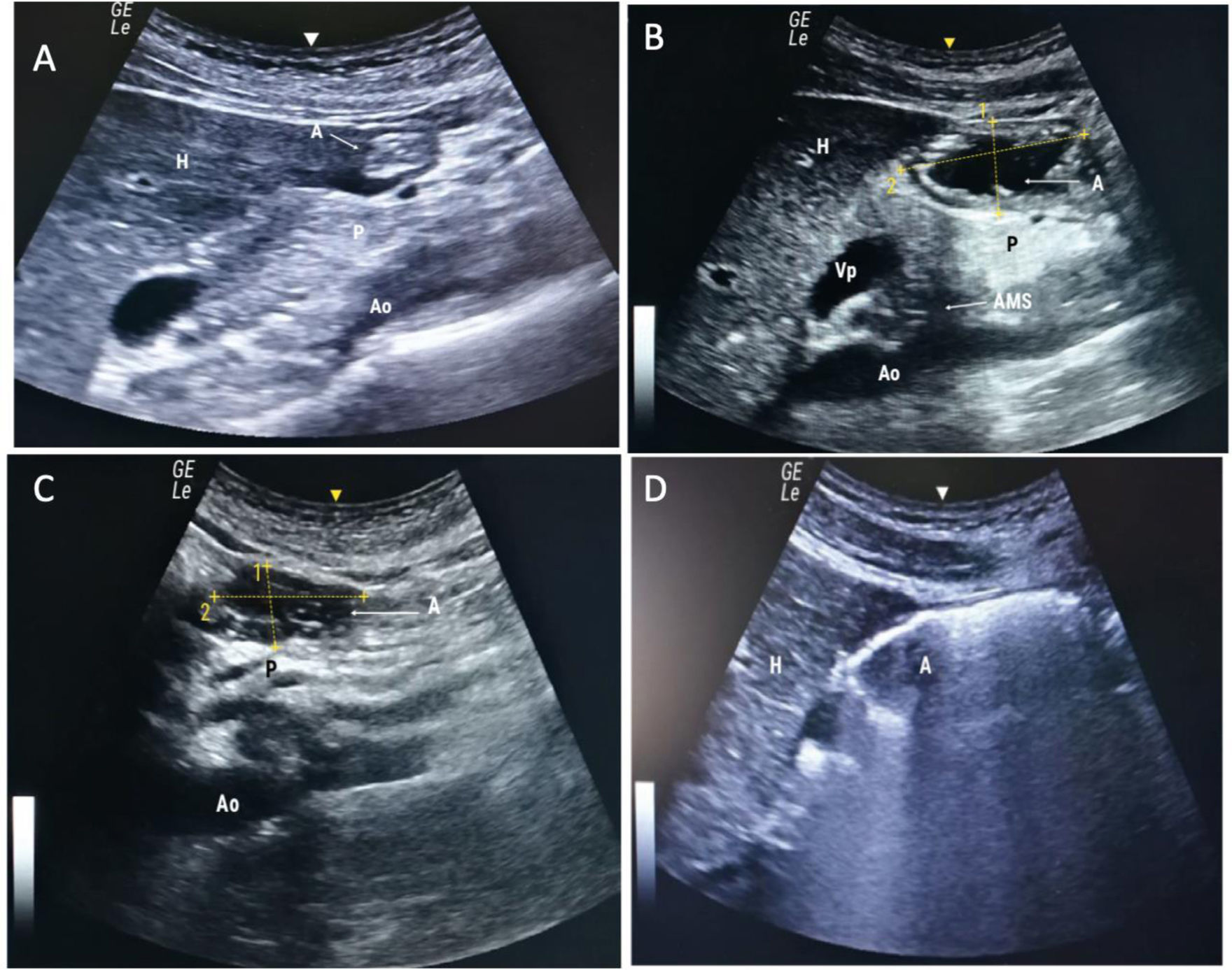 Gastric POCUS, an emergent tool in the assessment of perioperative ...