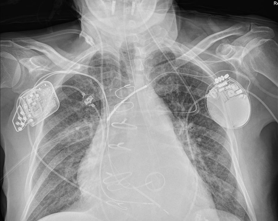 Anaesthesia management in a patient with a cardiac contractility ...