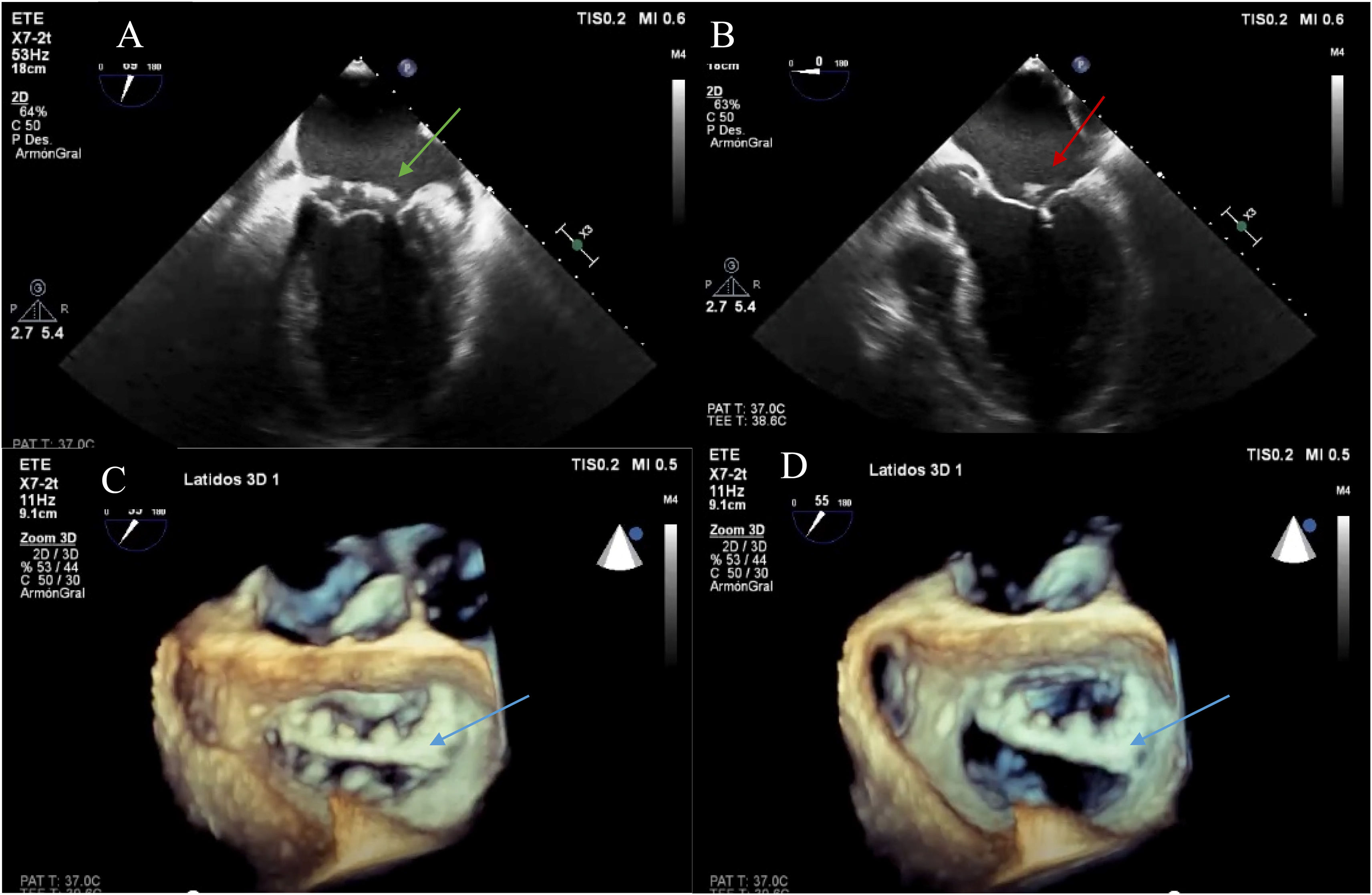 Three-dimensional transesophageal echocardiography for the differential ...