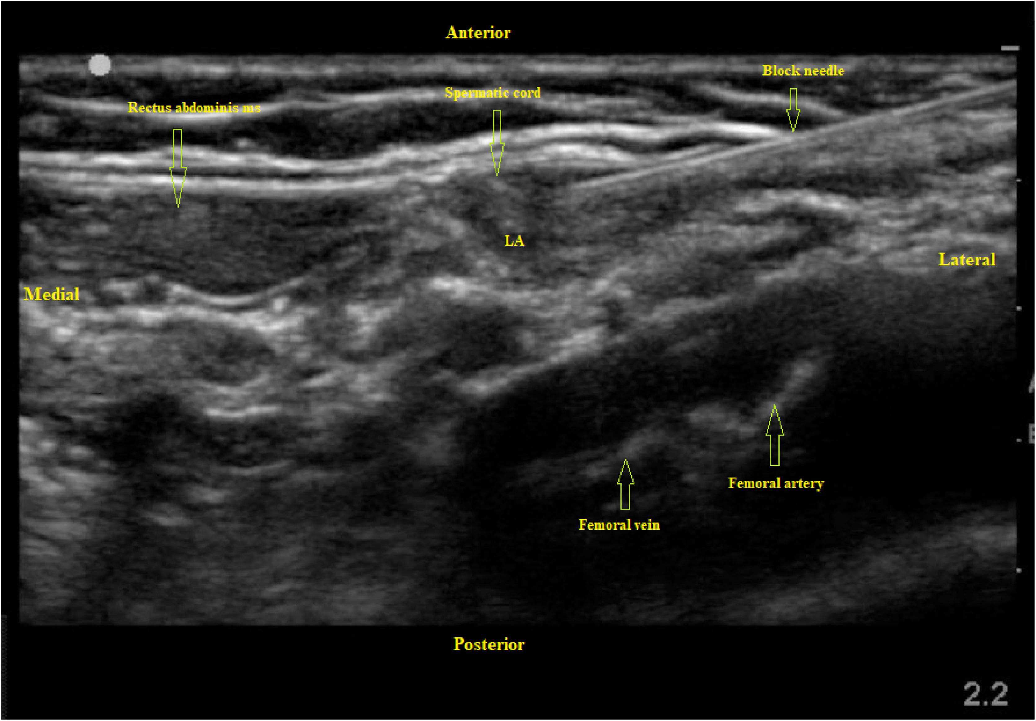 Efficacy of combining ultrasound-guided spermatic cord block with ...