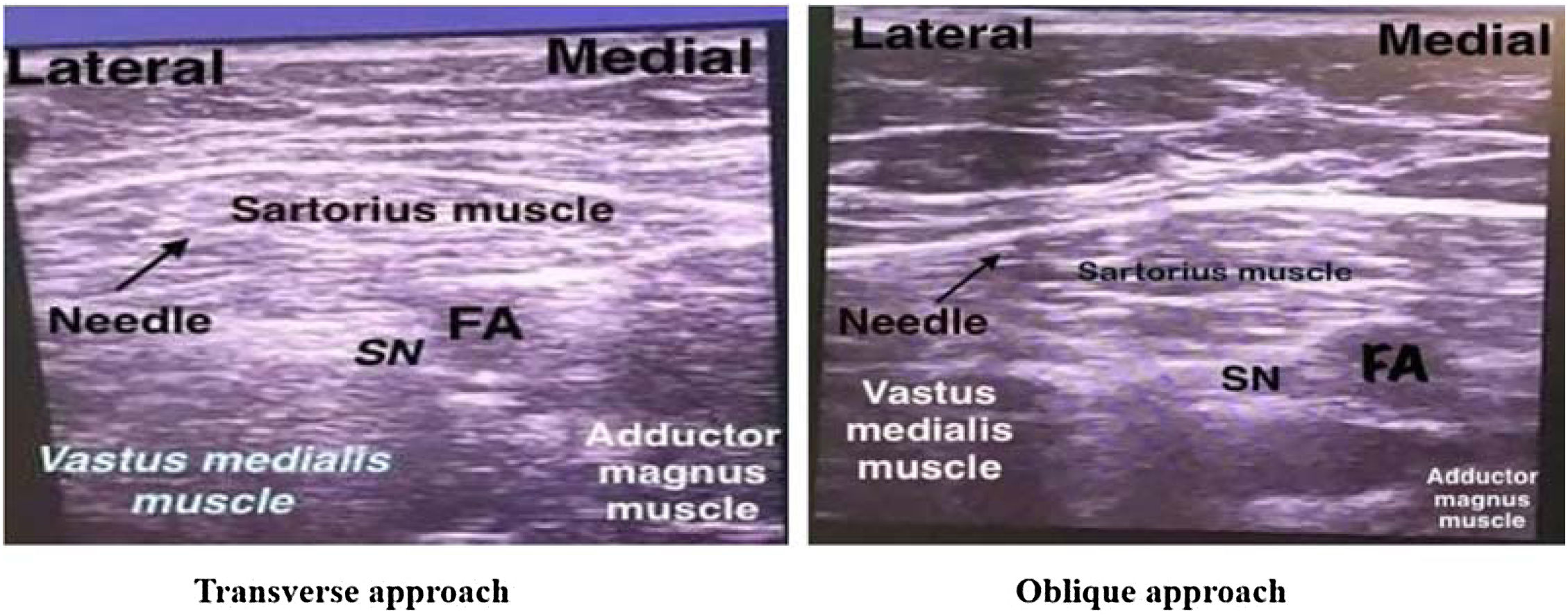 Ultrasound-guided oblique short-axis adductor canal block: Can the ...