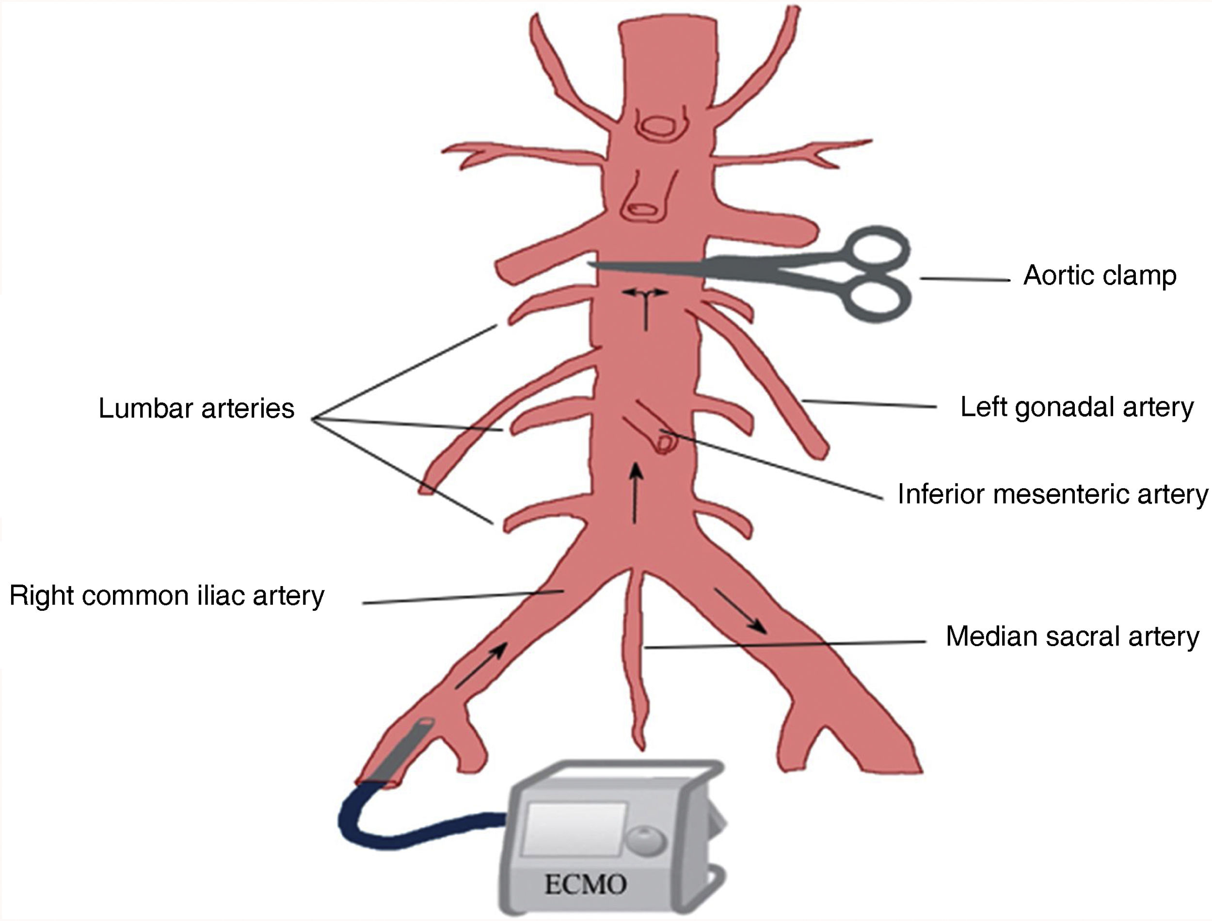 Veno-arterial extracorporeal membrane oxygenation (ECMO VA) as part of ...