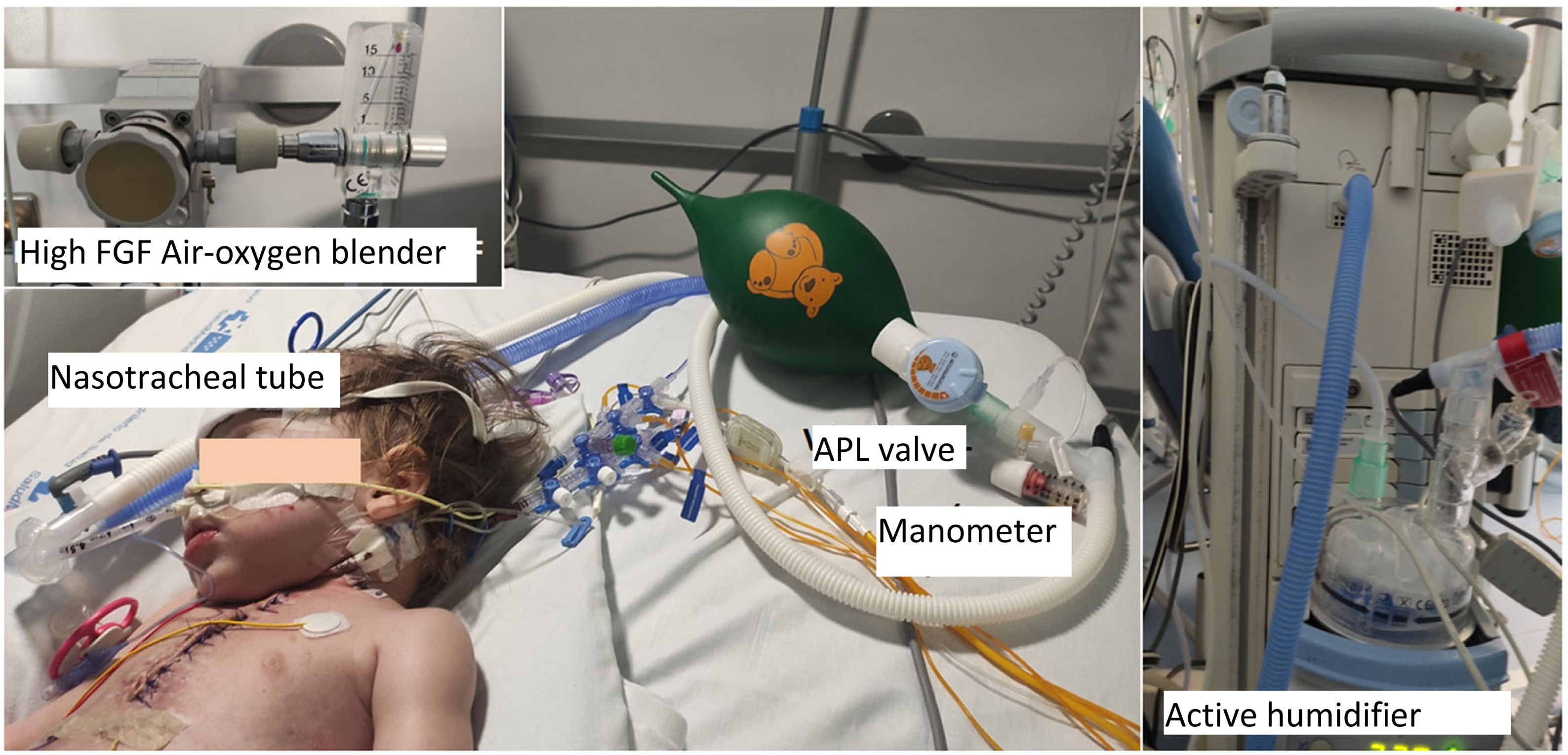 Clinical study on the predictive utility of high flow CPAP in weaning from prolonged mechanical ...