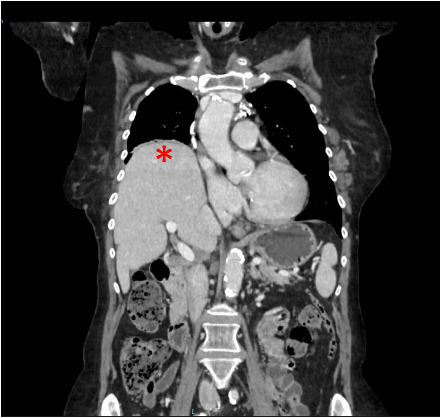 Hemidiaphragmatic elevation and cardiovascular collapse | Revista ...