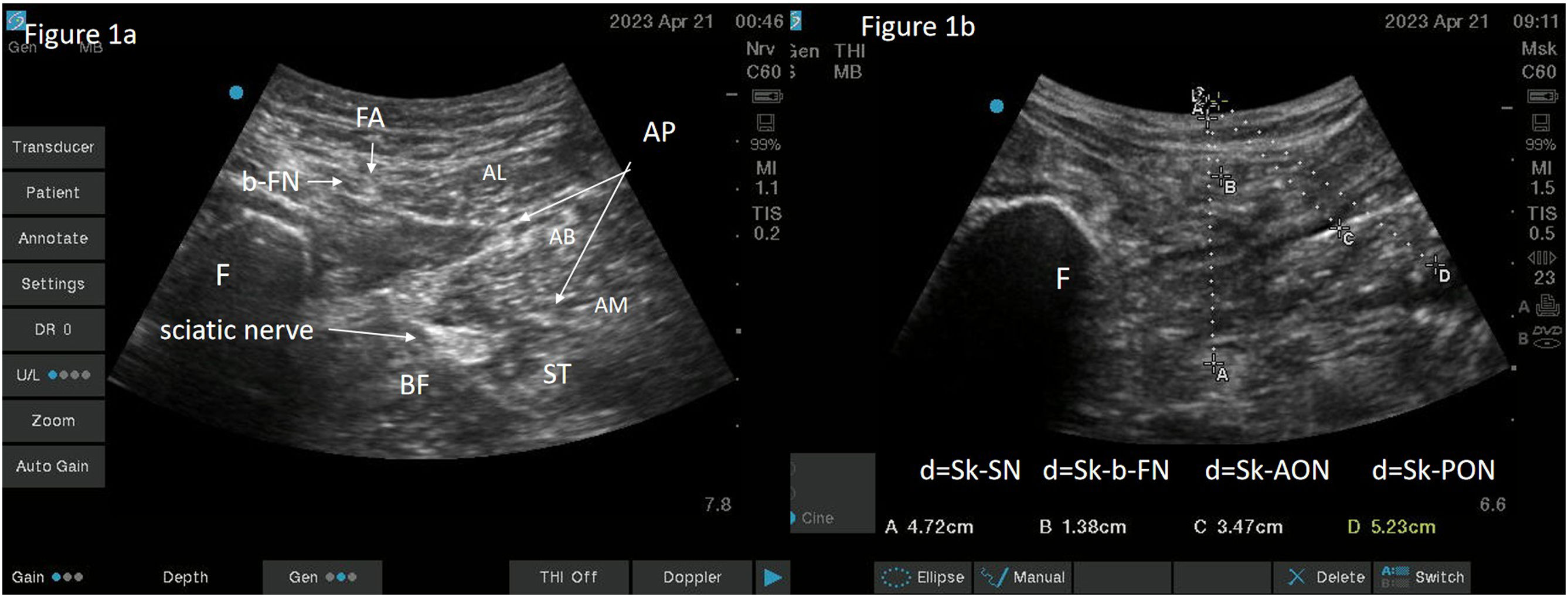 Single-puncture ultrasound-guided sciatic, femoral, and obturator ...