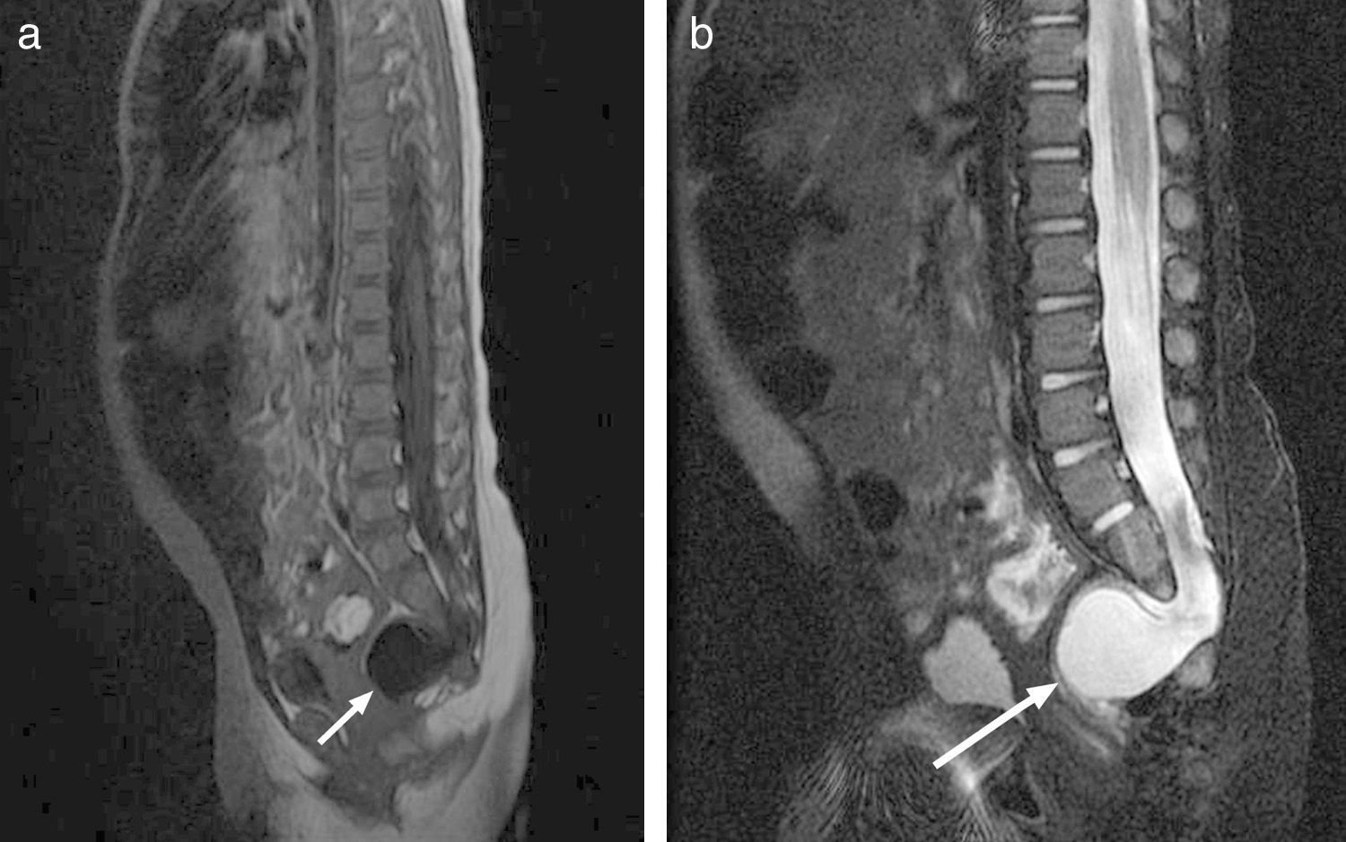 Recurrent meningitis due to anatomical defects: The bacteria indicates ...