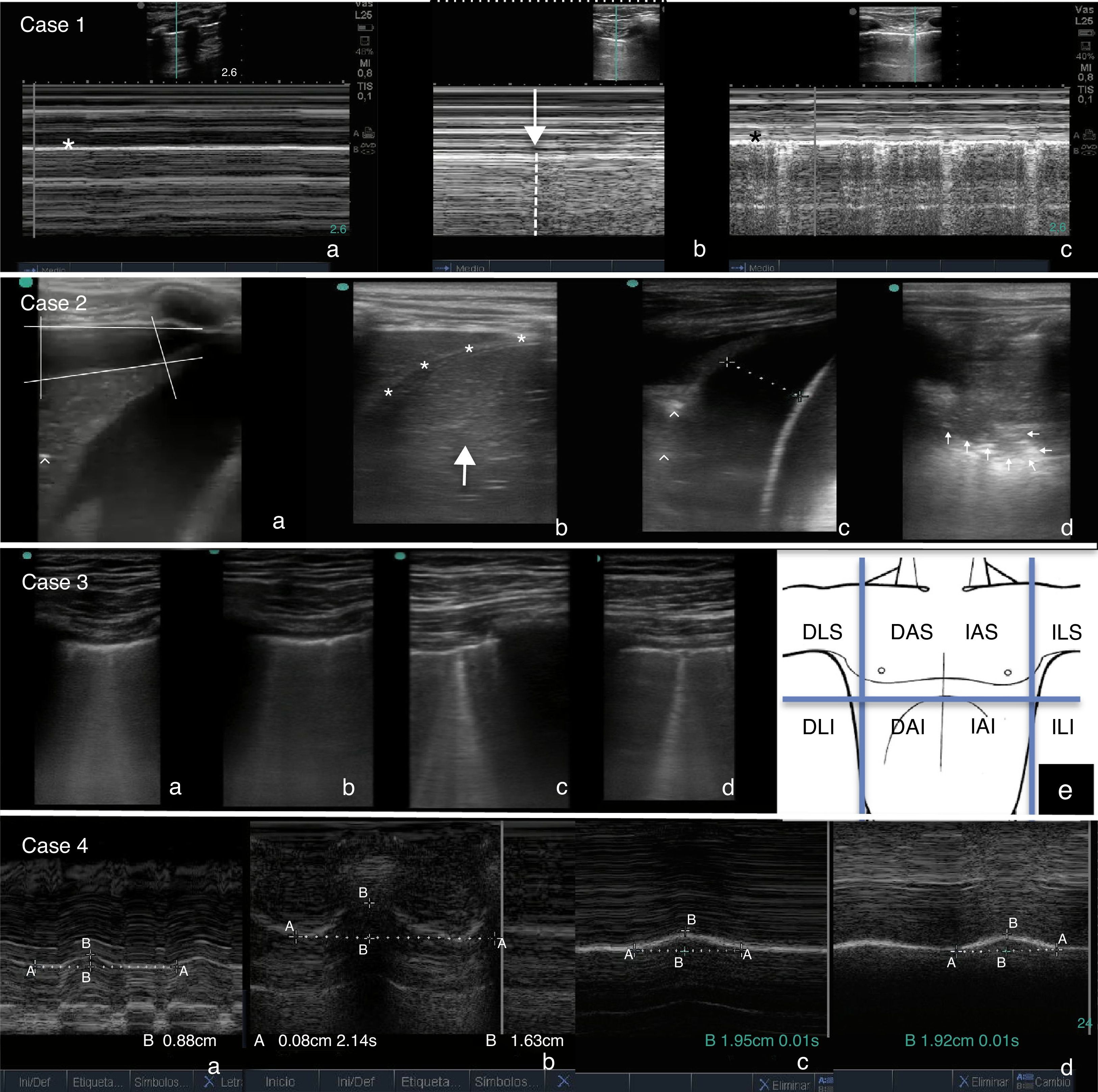 lung sliding pocus