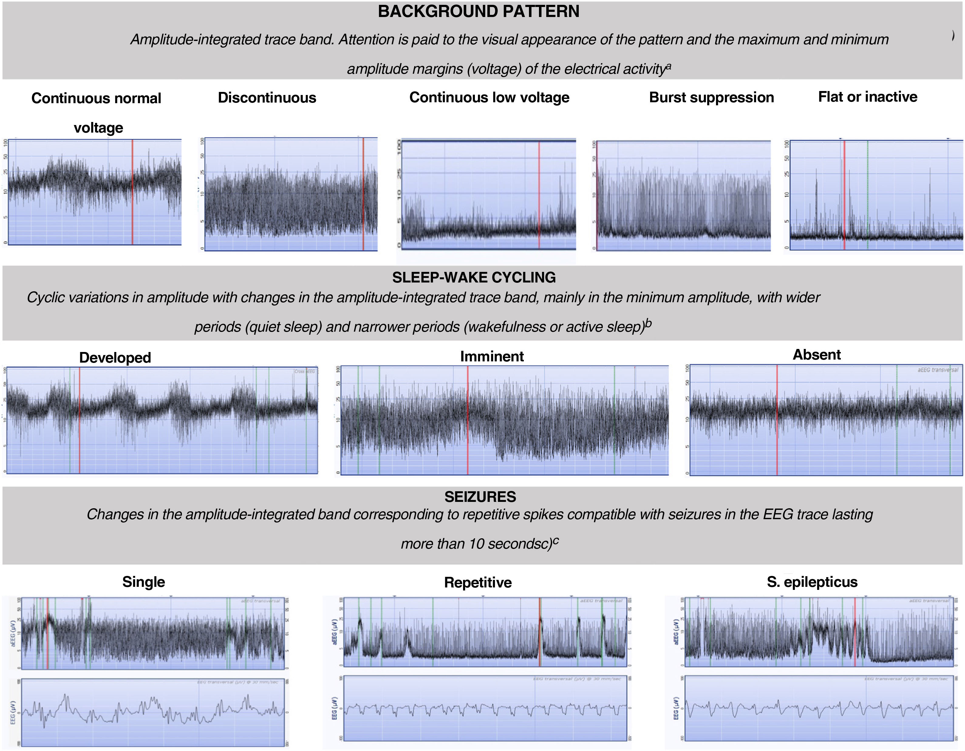 normal eeg tracing