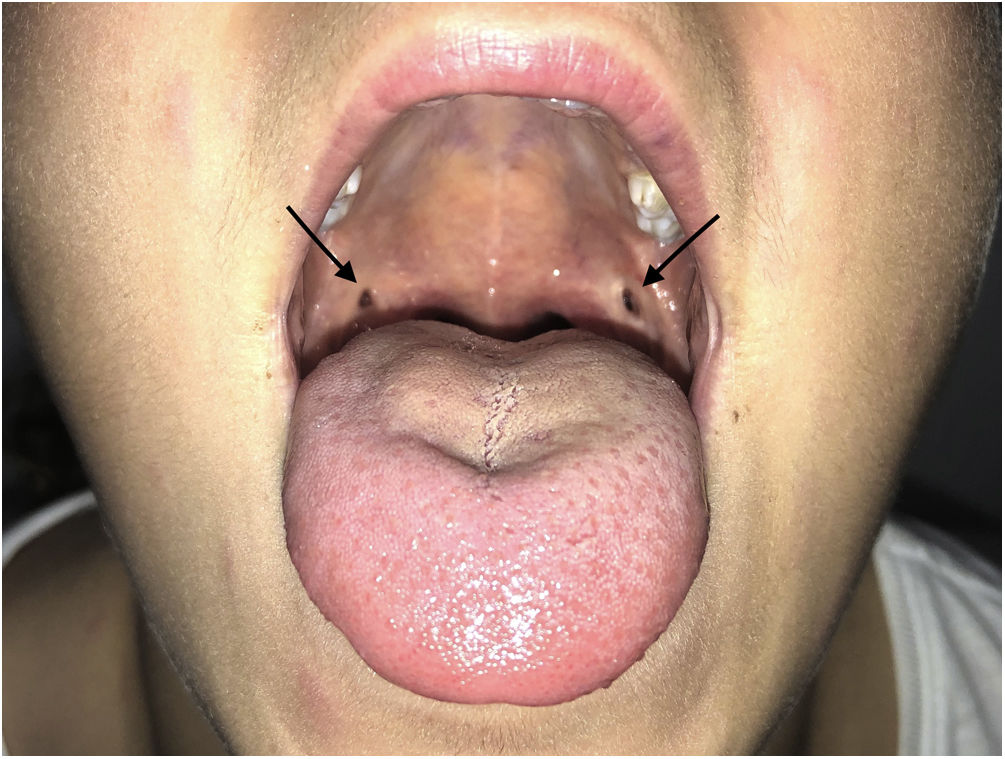 soft palate spot