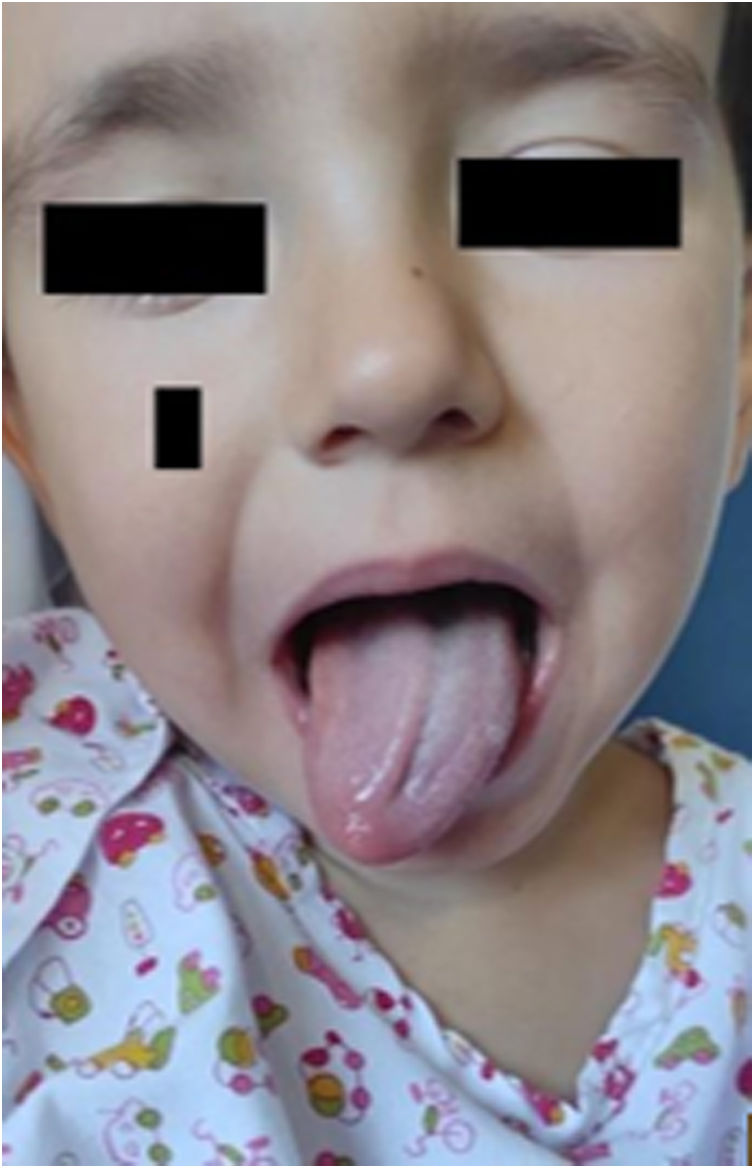 tongue deviation causes