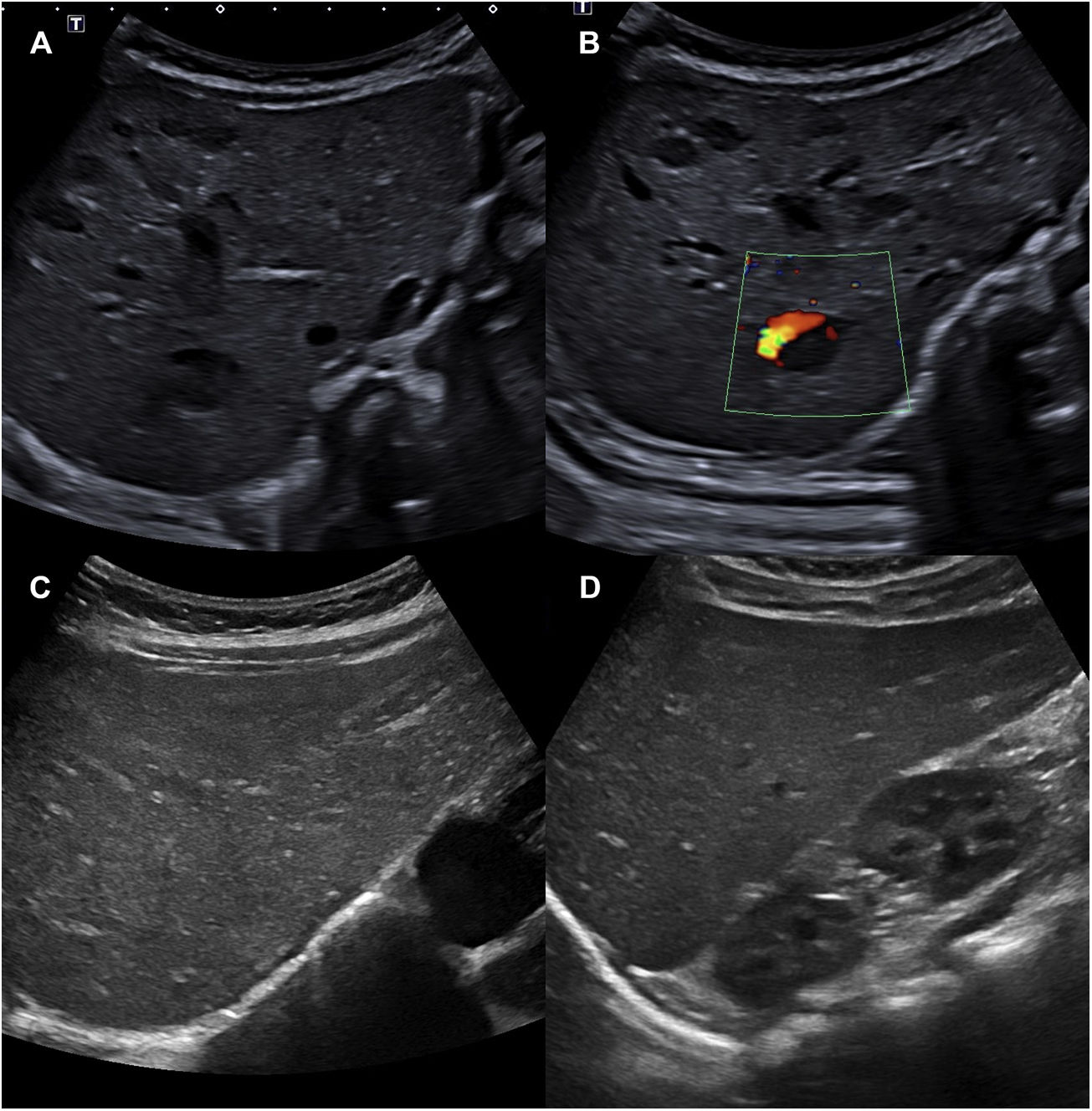 infantile hemangioma ultrasound